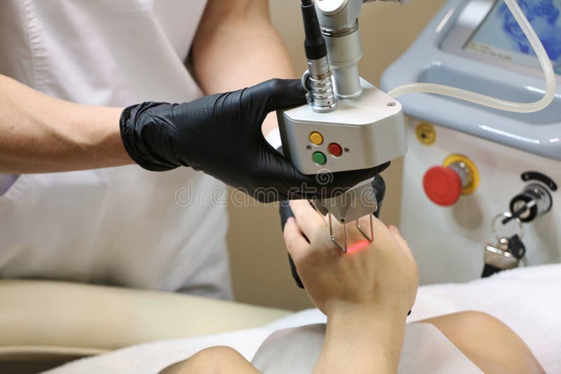 Laser Resurfacing of a Hand by a Cosmetologist Stock Image - Image of ...