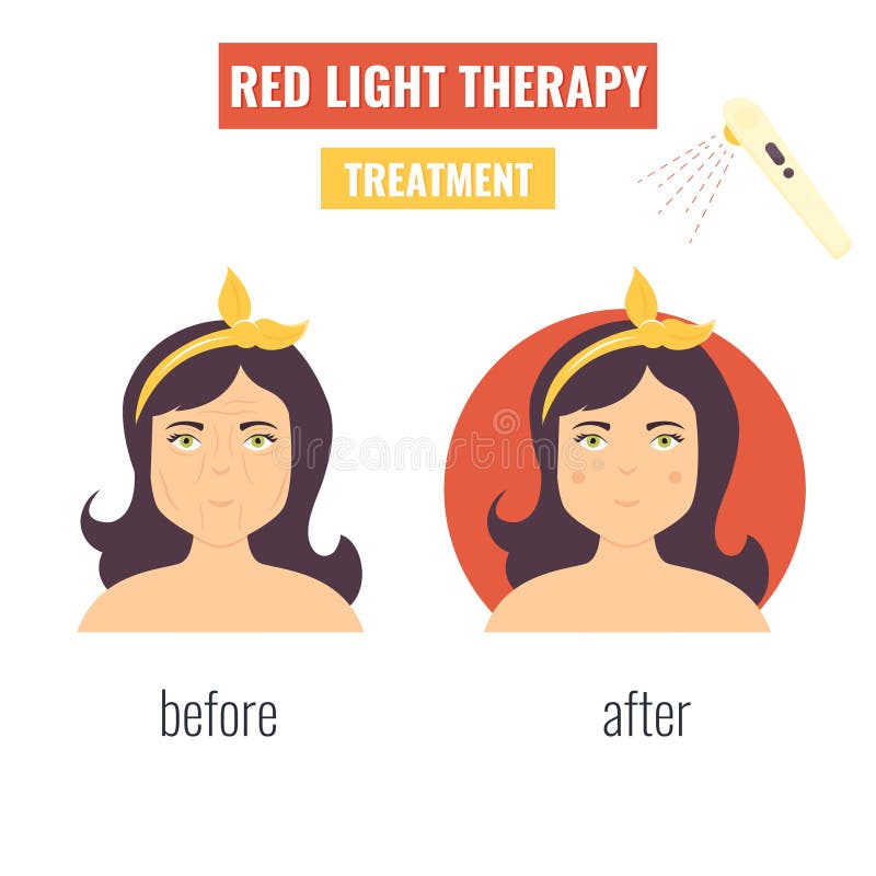 Phototherapy Stock Illustrations – 214 Phototherapy Stock Illustrations ...