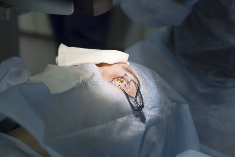 Laser Surgery for Vision Correction Stock Image - Image of optical ...