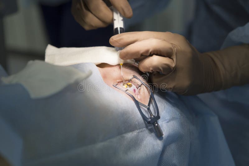 Laser Surgery for Vision Correction Stock Photo - Image of laser, lens ...