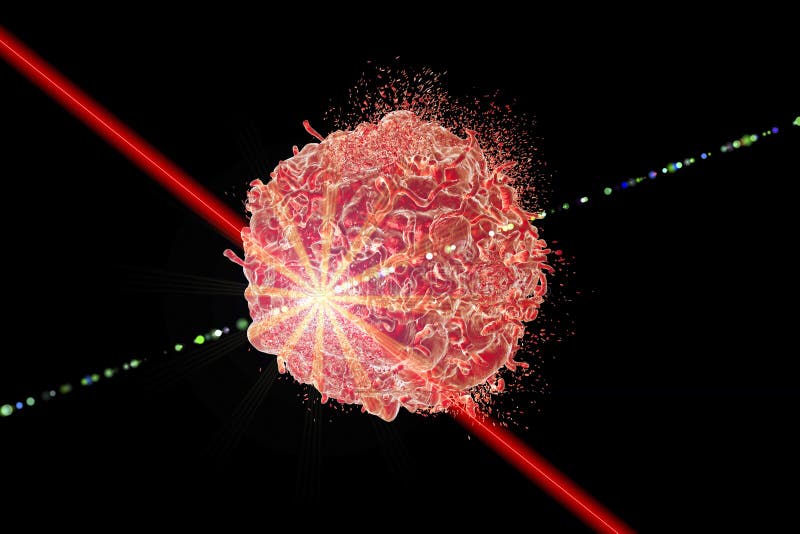 Laser Therapy of Cancer Concept Stock Illustration - Illustration of ...