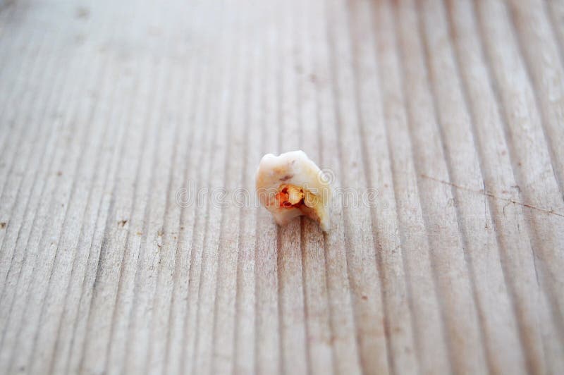 The Last Primary Tooth of a Kid Stock Image - Image of clinic, human ...