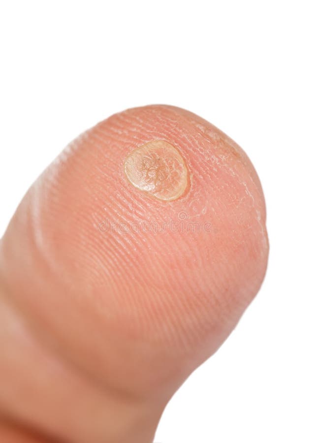 628 Verruca Stock Photos - Free & Royalty-Free Stock Photos from Dreamstime