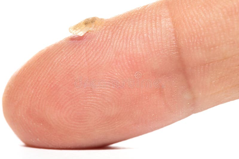 Last stage of verruca stock image. Image of quit, nitrogen - 30705049