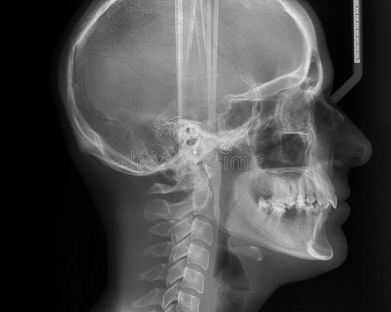 Lateral Cephalometric Radiograph Stock Image - Image of cephalometric ...