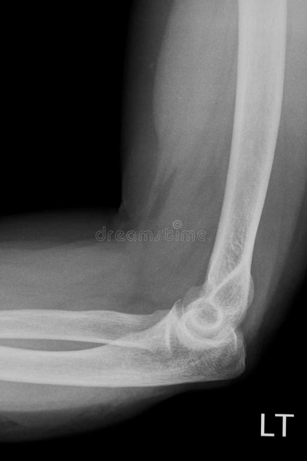Lateral elbow x-ray stock image. Image of anatomy, vertical - 15325743