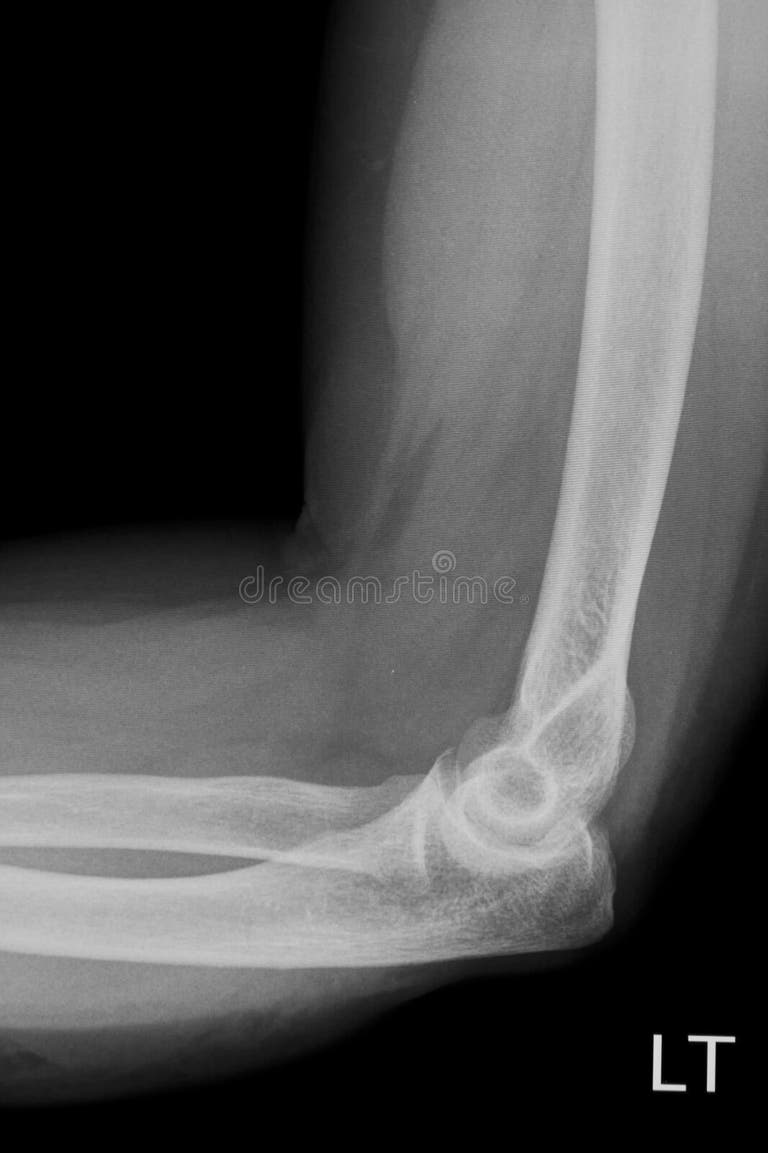 1,439 Elbow Muscle Anatomy Stock Photos - Free & Royalty-Free Stock ...