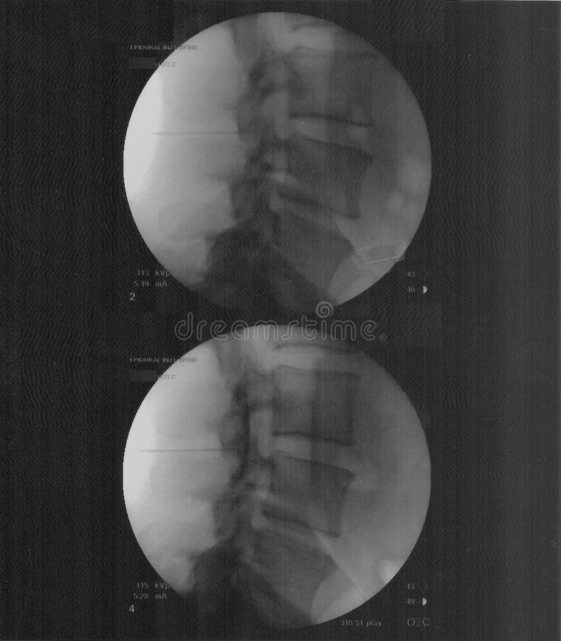 Lateral Epidural Injection stock image. Image of epidural - 13673067