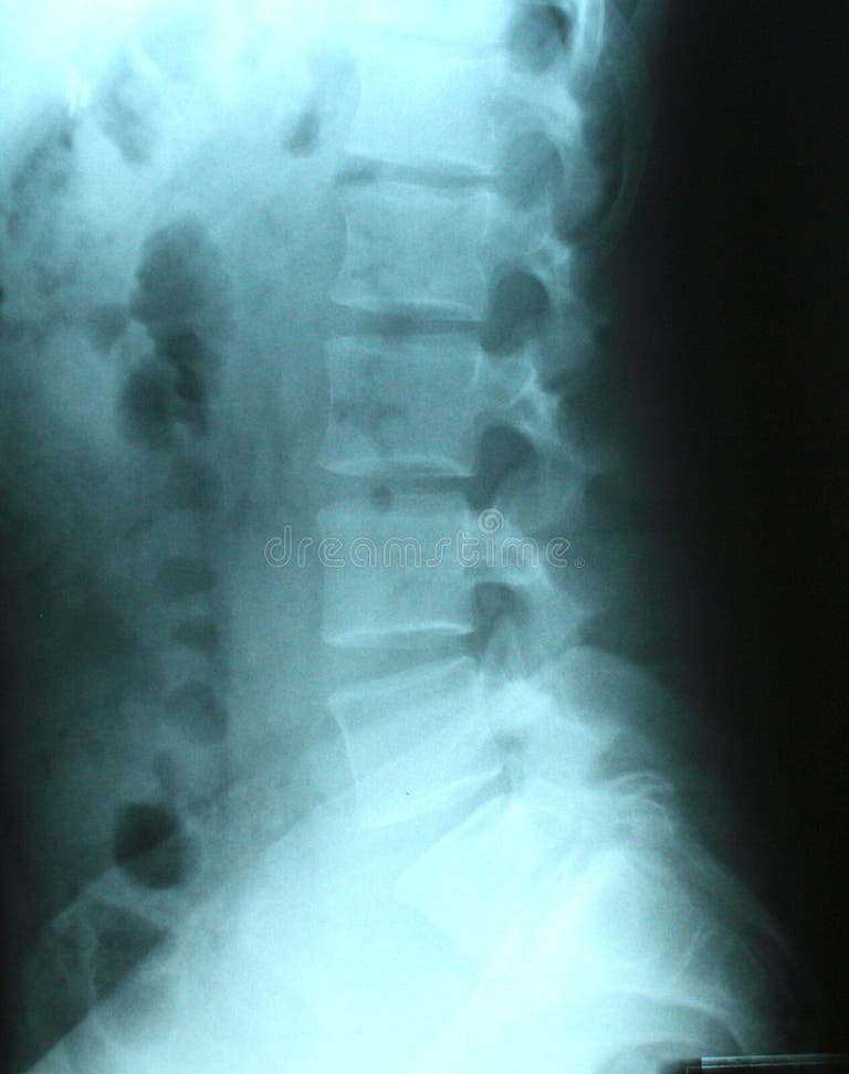 131 Lumbar Spine Ray Lateral Stock Photos - Free & Royalty-Free Stock ...