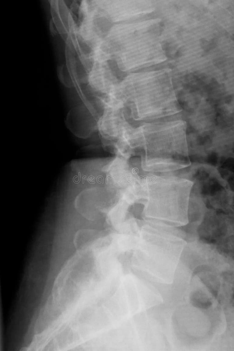 429 Lateral Spine Stock Photos - Free & Royalty-Free Stock Photos from ...