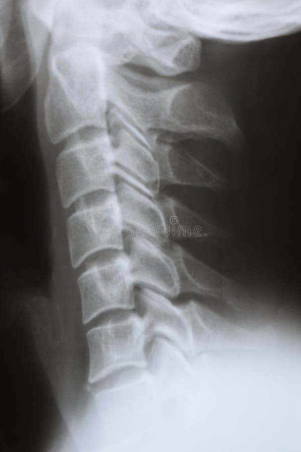 Lateral X-ray of the Neck and Cervical Spine of a Person Stock Photo ...