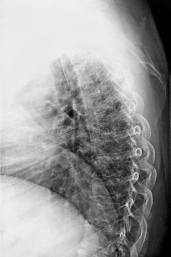 Lateral T-spine X-ray stock photo. Image of radiography - 7255282