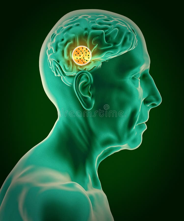 Lateral View of a Brain of an Elderly Man. Neurons and Synapses ...