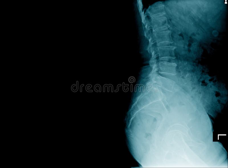 Lateral View of Human Spine Stock Image - Image of decompression ...