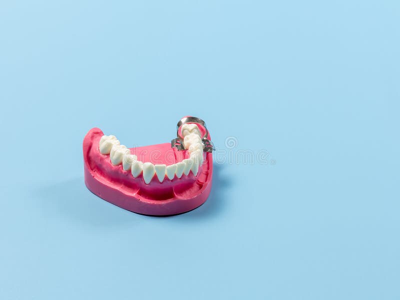 Layout of the Human Jaw with the Clamp on Blue. Stock Image - Image of ...