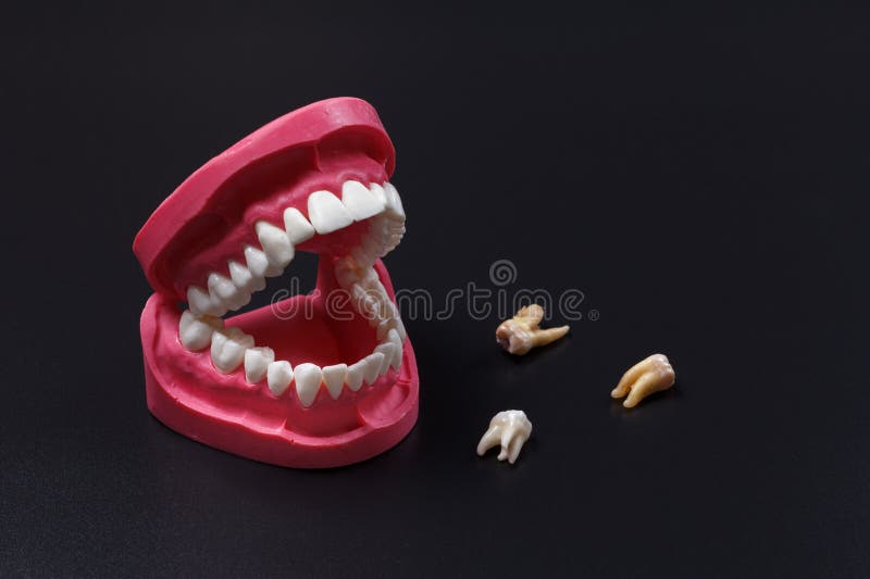 Layout of the Human Jaw and Extracted Sick Teeth Stock Image - Image of ...
