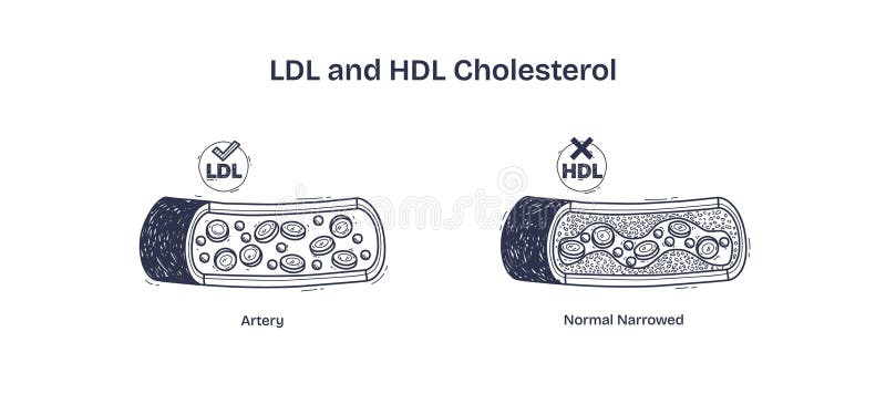 LDL and HDL Cholesterol Diagram Shows Artery Health. Key Objects ...