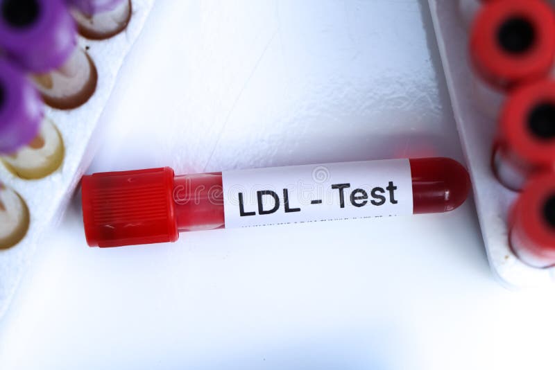 LDL Test To Look for Abnormalities from Blood Stock Photo - Image of ...