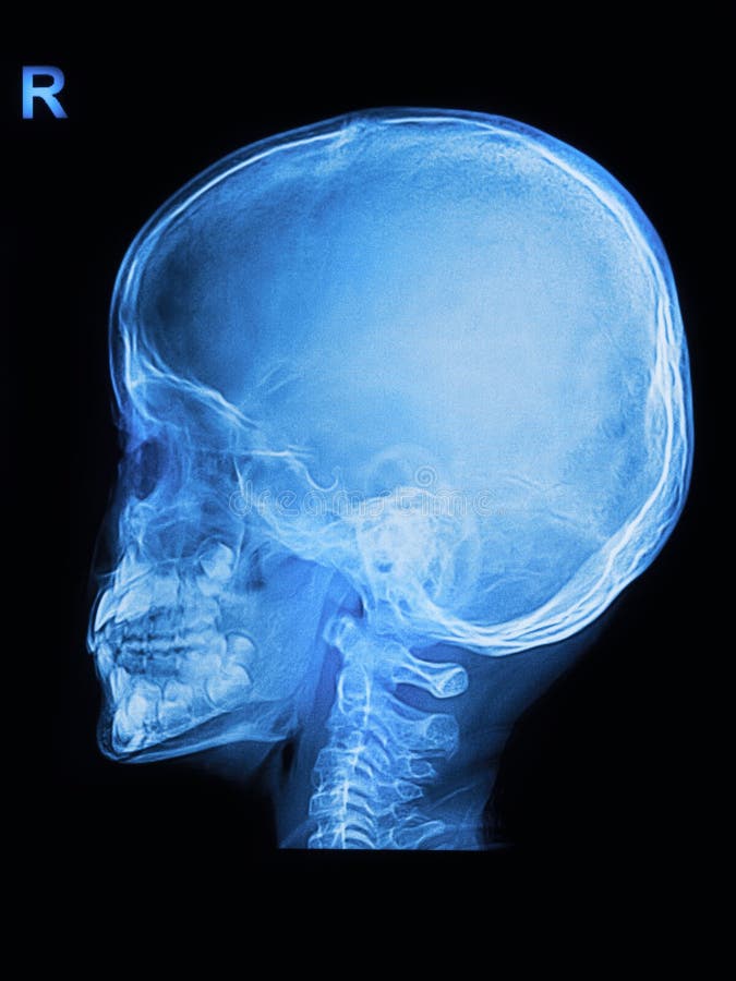 Le Crâne D'enfants Radiographie L'image Image stock - Image du enfants ...