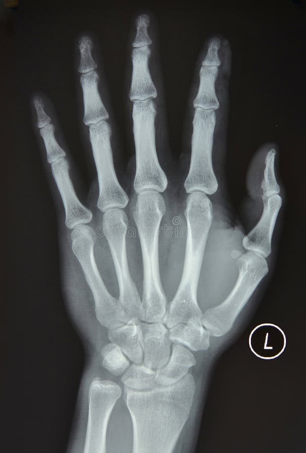 Le rayon X de main gauche photo stock. Image du anatomie - 34392402