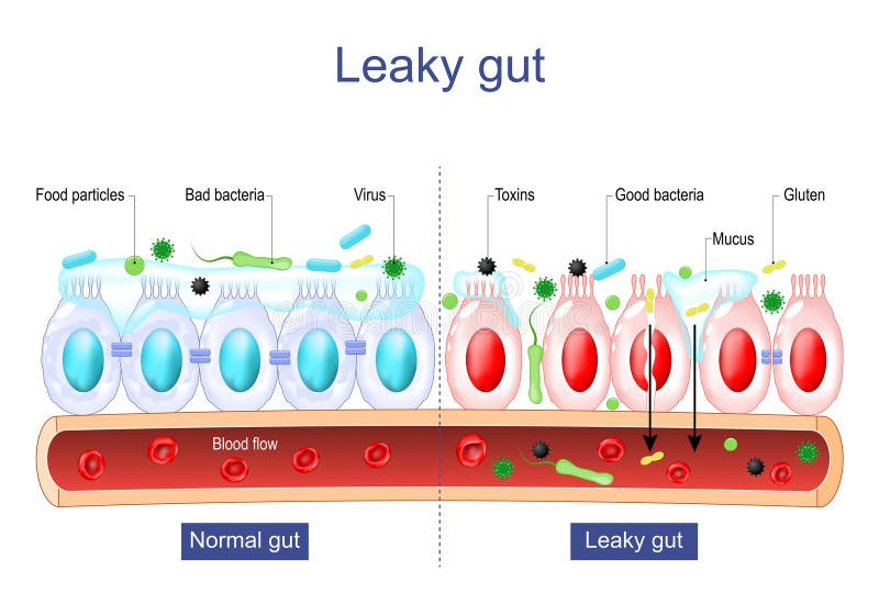 Leaky Gut. Intestinal Permeability. Gut Barrier Dysfunction Stock ...