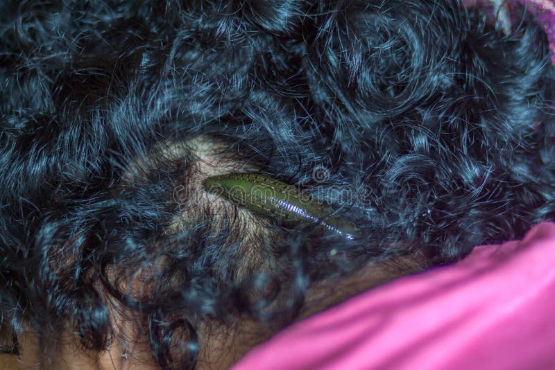 Leech Therapy Session on the Back of the Head Stock Photo - Image of ...