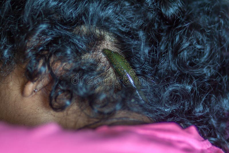 Leech Therapy Session on the Back of the Head Stock Photo - Image of ...