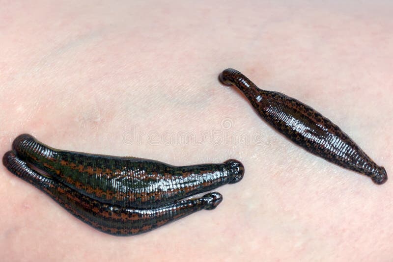 Leeches on the skin stock photo. Image of parasite, group - 70503556