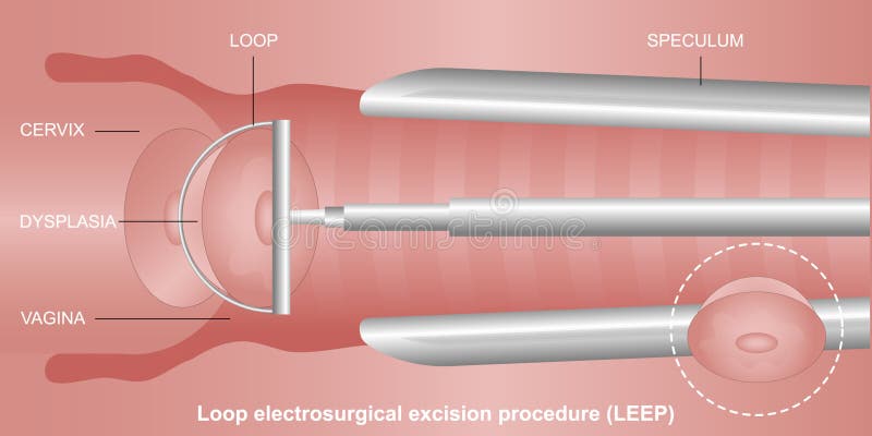 A Leep Loop Electrosurgical Excision Procedure Stock Vector