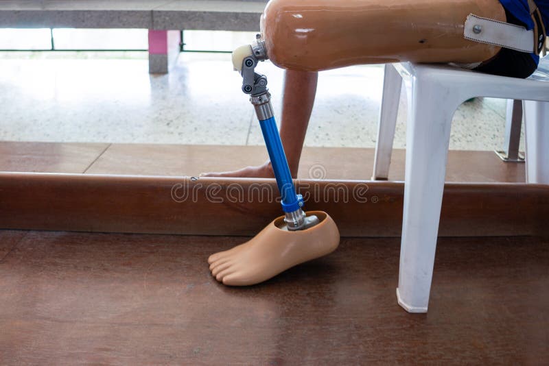 Left Leg Prosthesis Self-assured Man Wearing Shorts, Man with Amputee ...