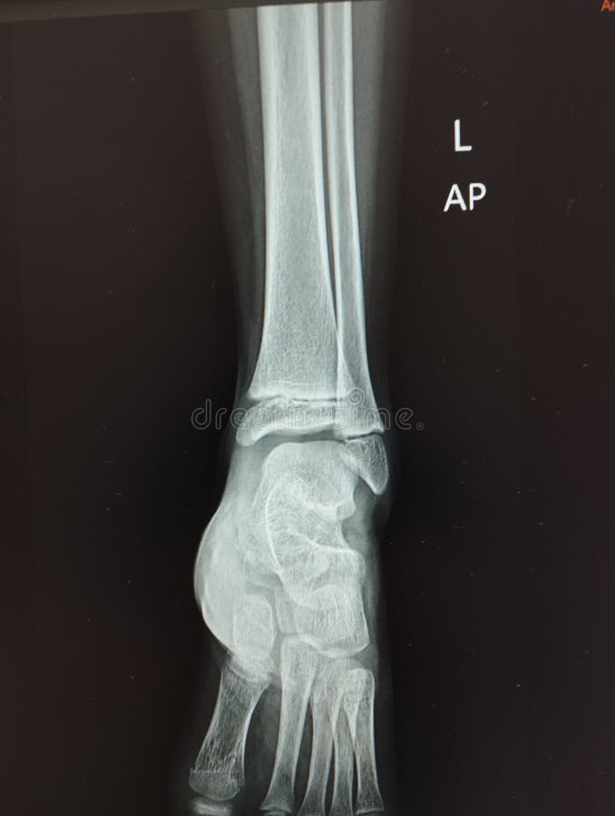 123 Lateral Bone Arm Stock Photos - Free & Royalty-Free Stock Photos ...