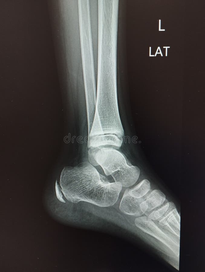 Normal Left Ankle Xray