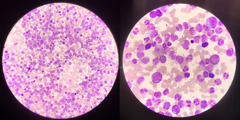 Left Anormal Blood Smear 40x Microscope,Right Anormal Blood Smear 100x ...