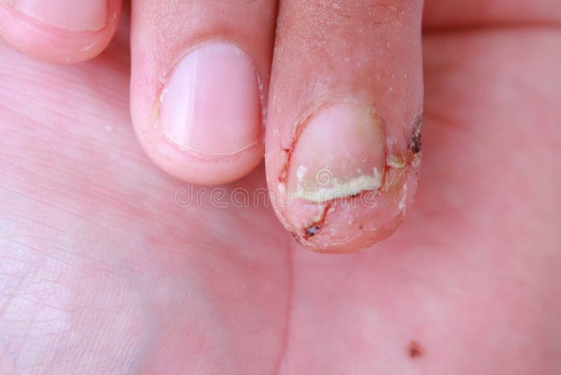 Left finger cut stock image. Image of recovery, painful - 19092401