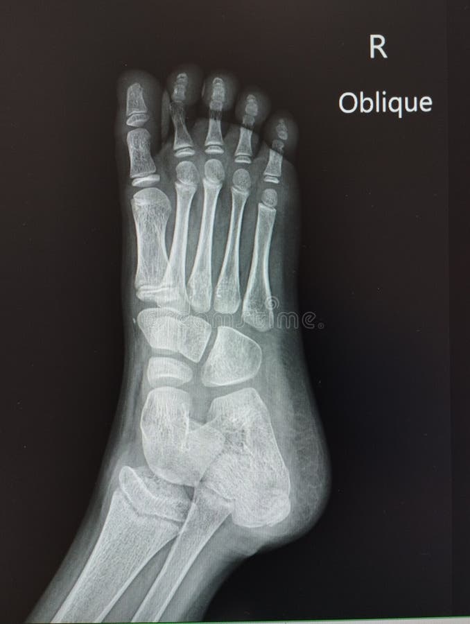Normal Left Hand X Ray