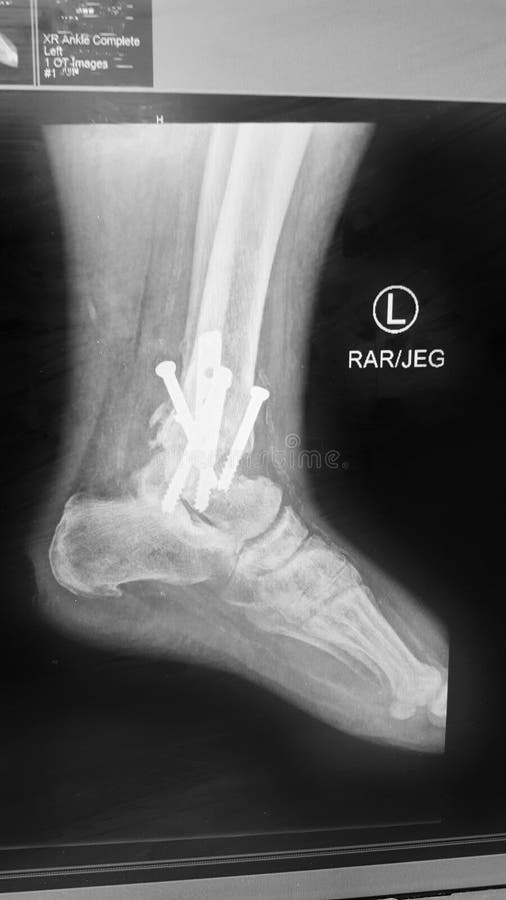 Left Foot Ankle Replacement Hardware - Plain X Ray Stock Photo - Image ...