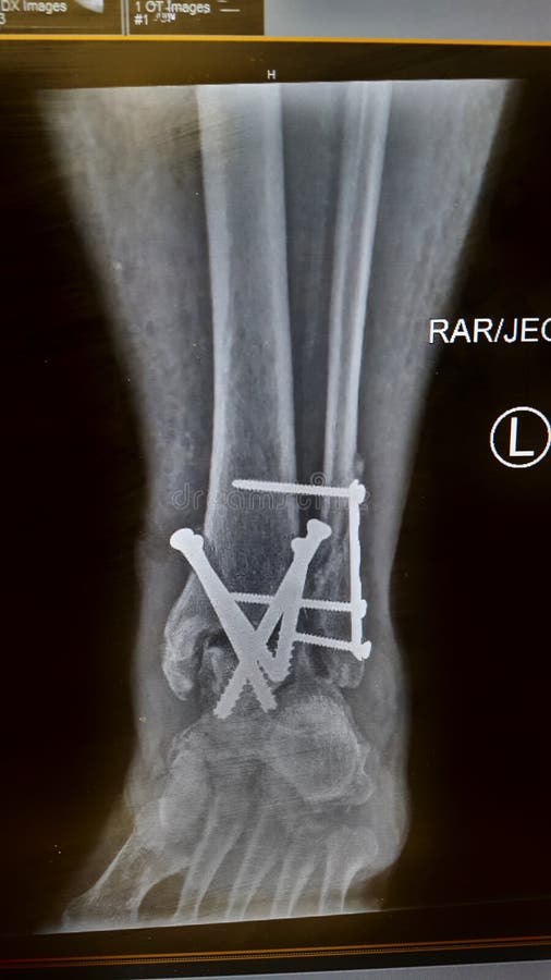 Left Foot Ankle Replacement Hardware - Plain X Ray Stock Image - Image ...