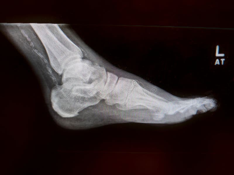 Left Foot Normal Radiograph - Plain X Ray Stock Image - Image of check ...