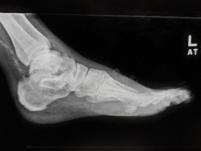 Left Foot Normal Radiograph - Plain X Ray Stock Photo - Image of trauma ...
