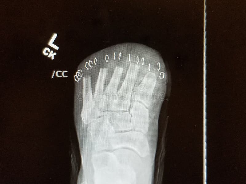 Left Foot Transmetatarsal Amputation with Staples - Plain X-ray Stock ...