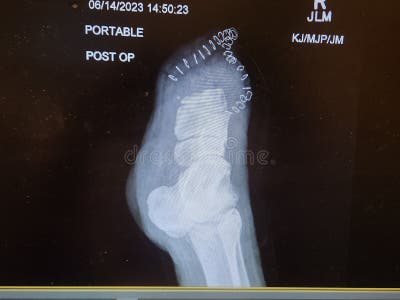 Left Foot Transmetatarsal Amputation with Staples - Plain X-ray Stock ...