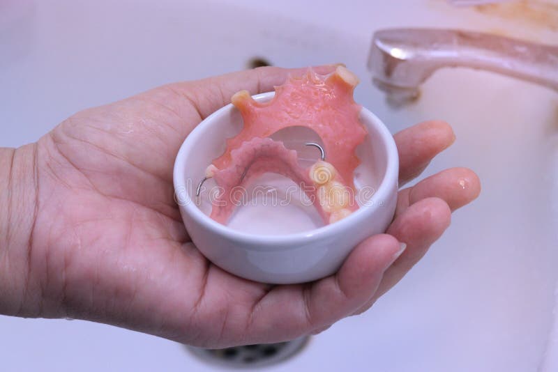 Lower Partial Denture with Attachments Stock Image - Image of ...