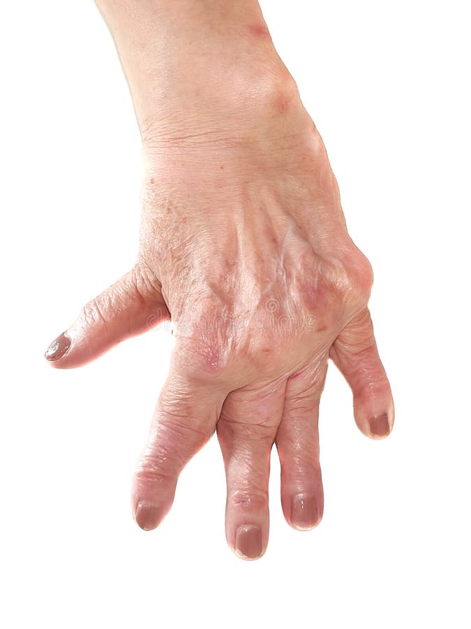 Hands and Fingers with Sequelae of Rheumatoid Arthritis, Arthrosis and ...