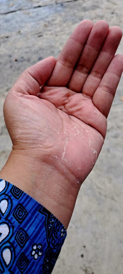 Left Hand with Peeling Skin Stock Image - Image of hand, peeling: 258920341