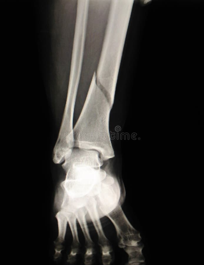 Leg fracture x-ray stock photo. Image of break, clinic - 17069904