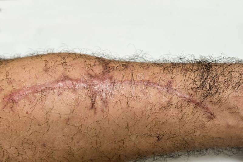 Surgical Scar on Female Body Stock Photo - Image of healthcare, beauty ...