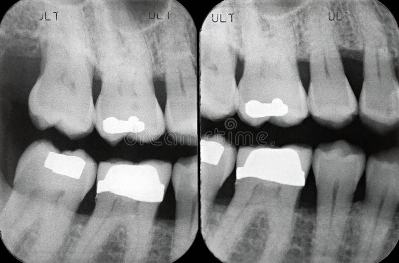 Total Periodontal Bone Loss Stock Photo - Image of radiograph ...