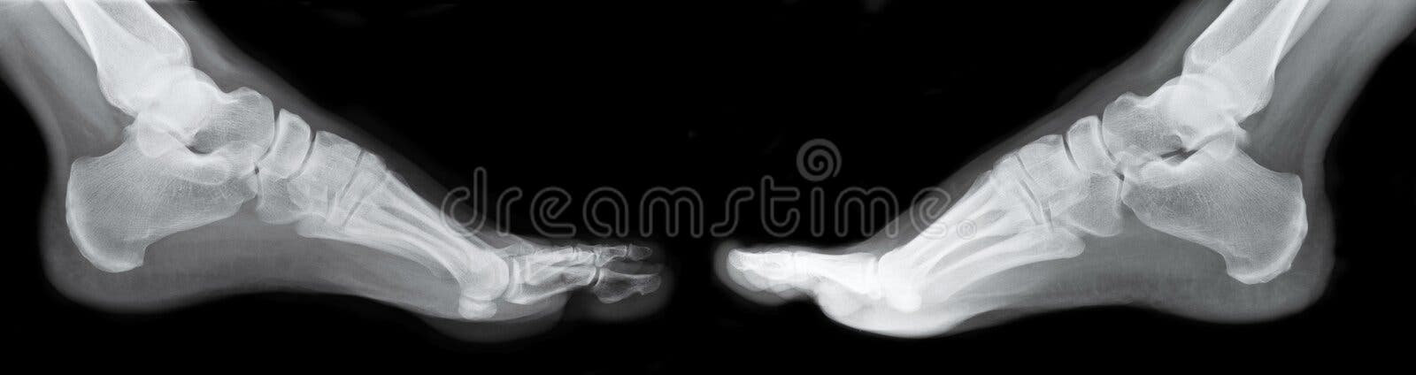 Right Foot Side X-ray stock image. Image of toes, right - 23691317
