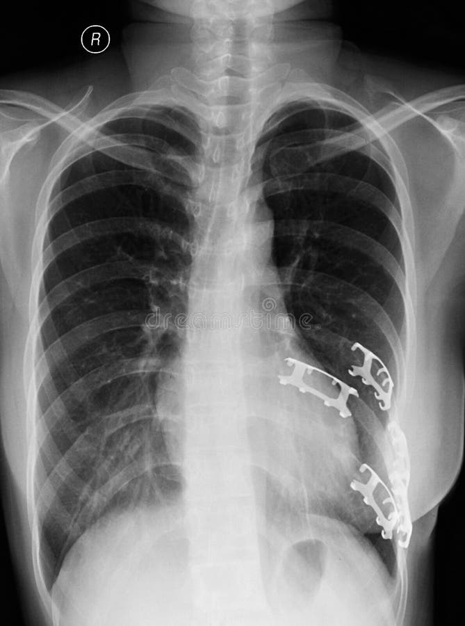Chest X-ray Fractures Left Clavicle, Anterior 2nd Rib, Posterior Rib 4 ...