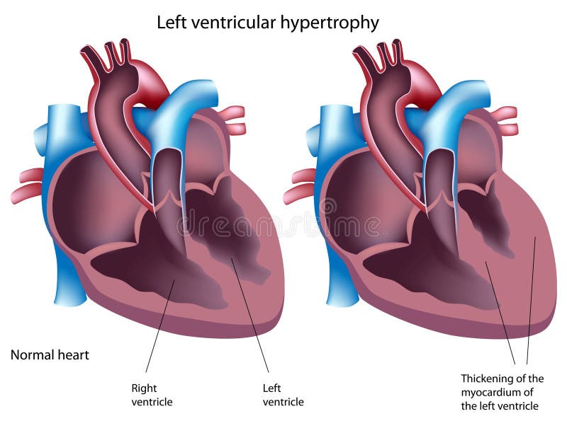 Left Ventricular Hypertrophy Stock Vector - Illustration of ...